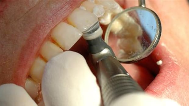 Tilskud til tandlæge rasler ned | Indland | DR