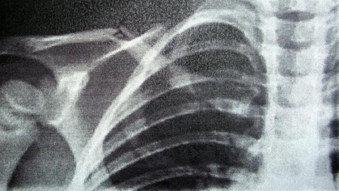 Det bliver nemmere at sende billeder af knækkede knogler ...