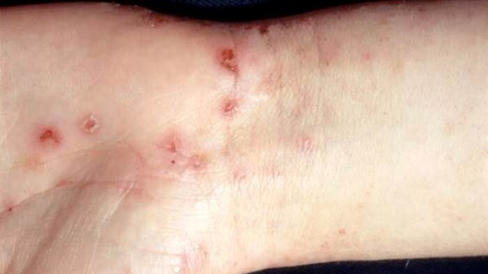 Fnat-udbrud: 'Det er den sygdom vi har i Danmark, der klør allermest ...