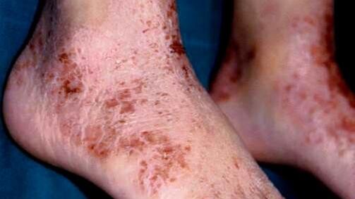 Ny lovende behandling for eksem på vej til Danmark | Naturvidenskab | DR