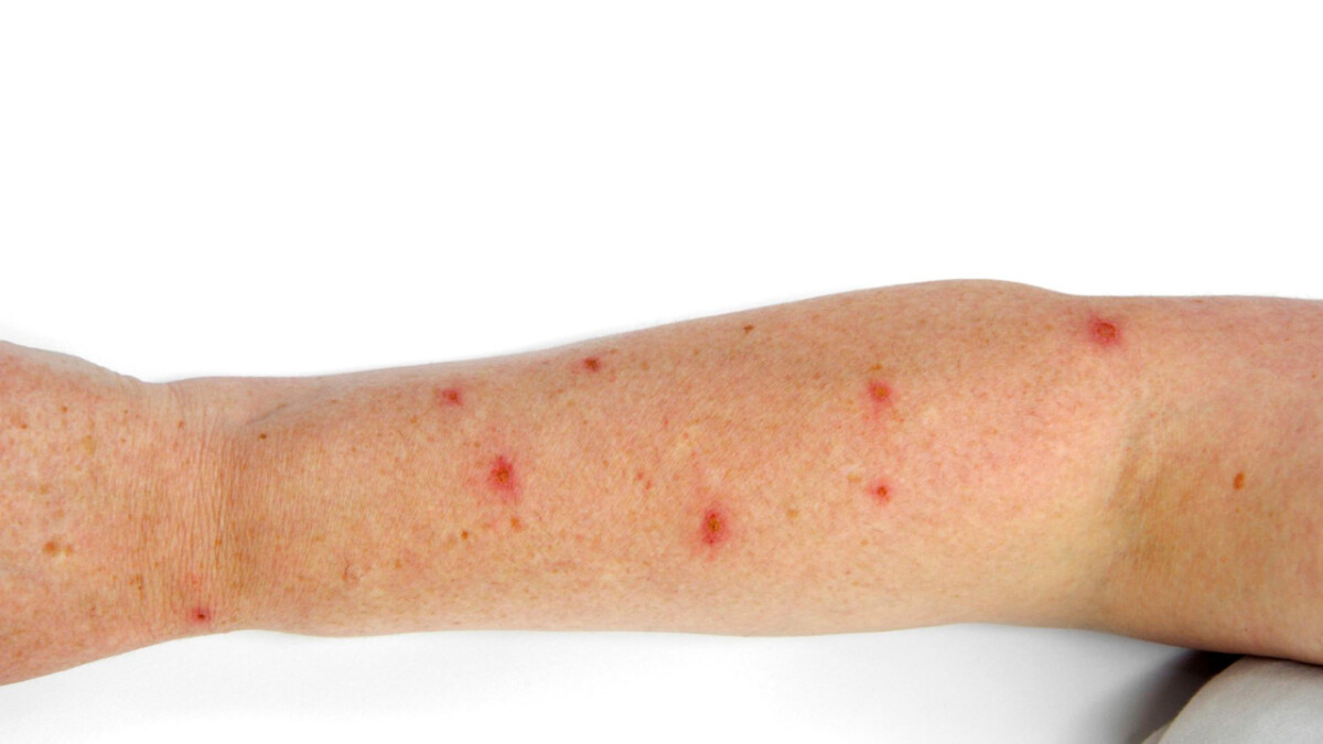 Fnat Symptomer Billeder - symptomer 2020