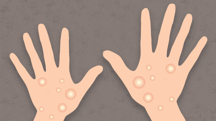 'Dyrk sikker sex' lyder rådet mod abekopper - men hvordan skal det ...