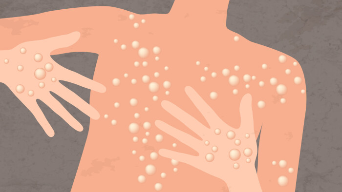 WHO: Abekopper skal have nyt navn | Ligetil på tegnsprog | DR